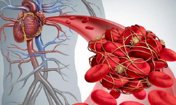 Derin Ven Trombozu-Pulmoner Tromboemboli Tedavisi - Doktor Makaleleri